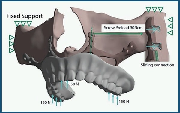 Subperiosteal Implants in Turkey - Karat Dental Clinic