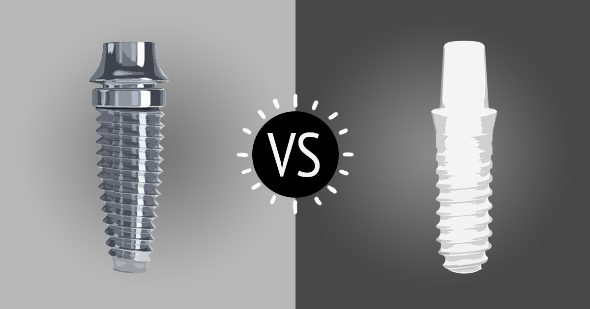 The Best Dental Implant Brands: A Comprehensive Clinical Review 2026