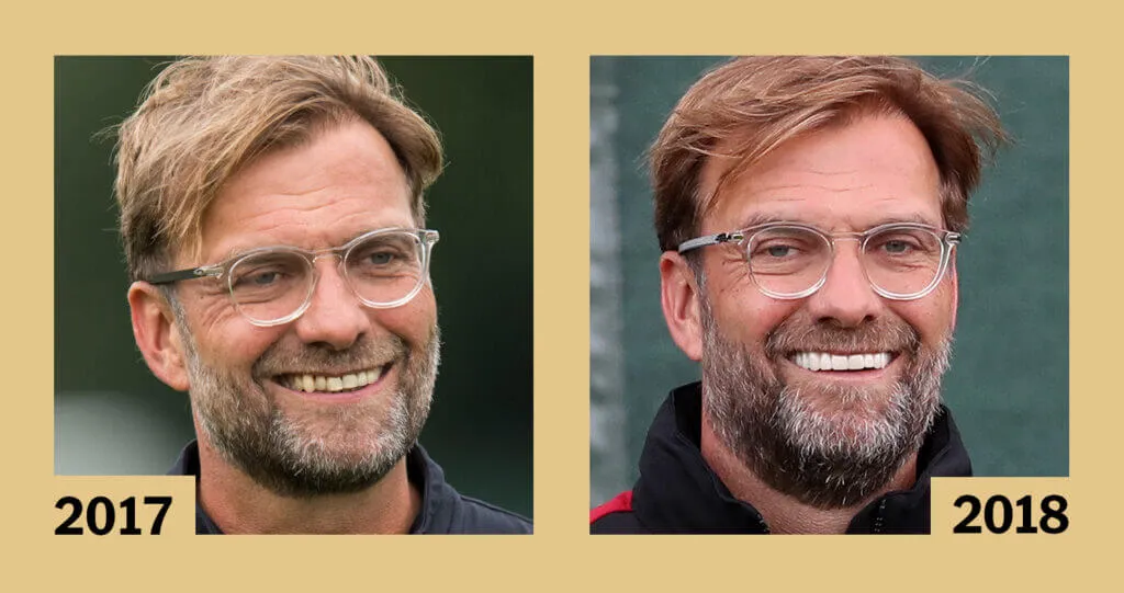 Jurgen Klopp Teeth: The Full Review of His $30,000 Smile Transformation