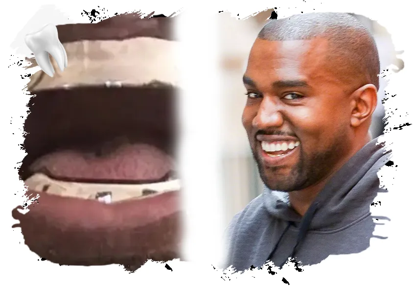 Kanye West Teeth: The $850K Titanium Transformation & Dental Secrets