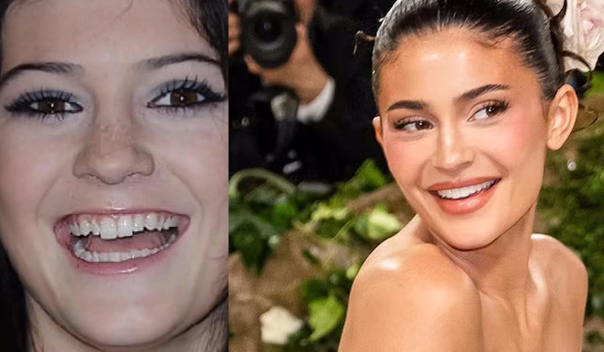 Kylie Jenner Teeth: The Full Evolution of a Billion-Dollar Smile ...