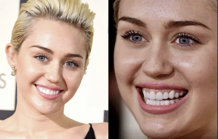 Miley Cyrus Teeth Before and After: The Evolution of a Global Superstar ...