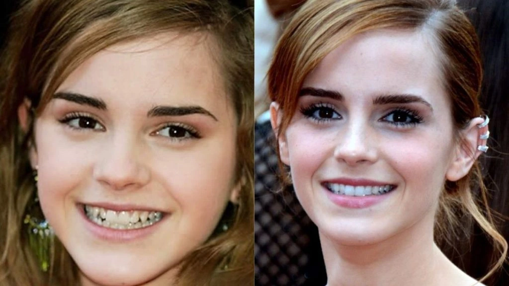 Emma Watson Teeth : The Ultimate Evolution of the Hermione Smile
