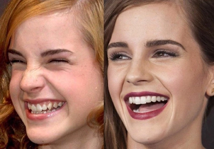 Emma Watson Teeth : The Ultimate Evolution of the Hermione Smile