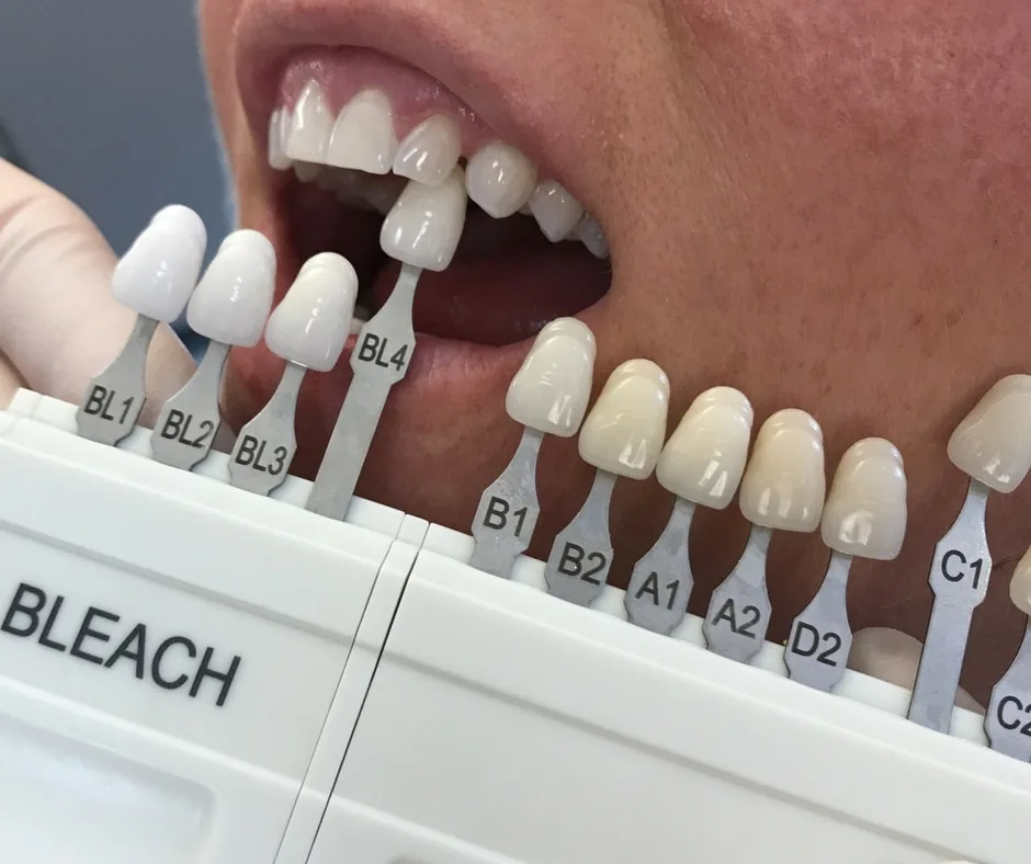 B1 vs. BL2 Tooth Shade: Which One for Your Hollywood Smile?