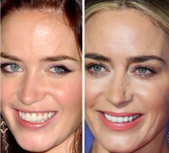 Emily Blunt Teeth 2026: Ultimate Before & After Dental Review | Expert ...