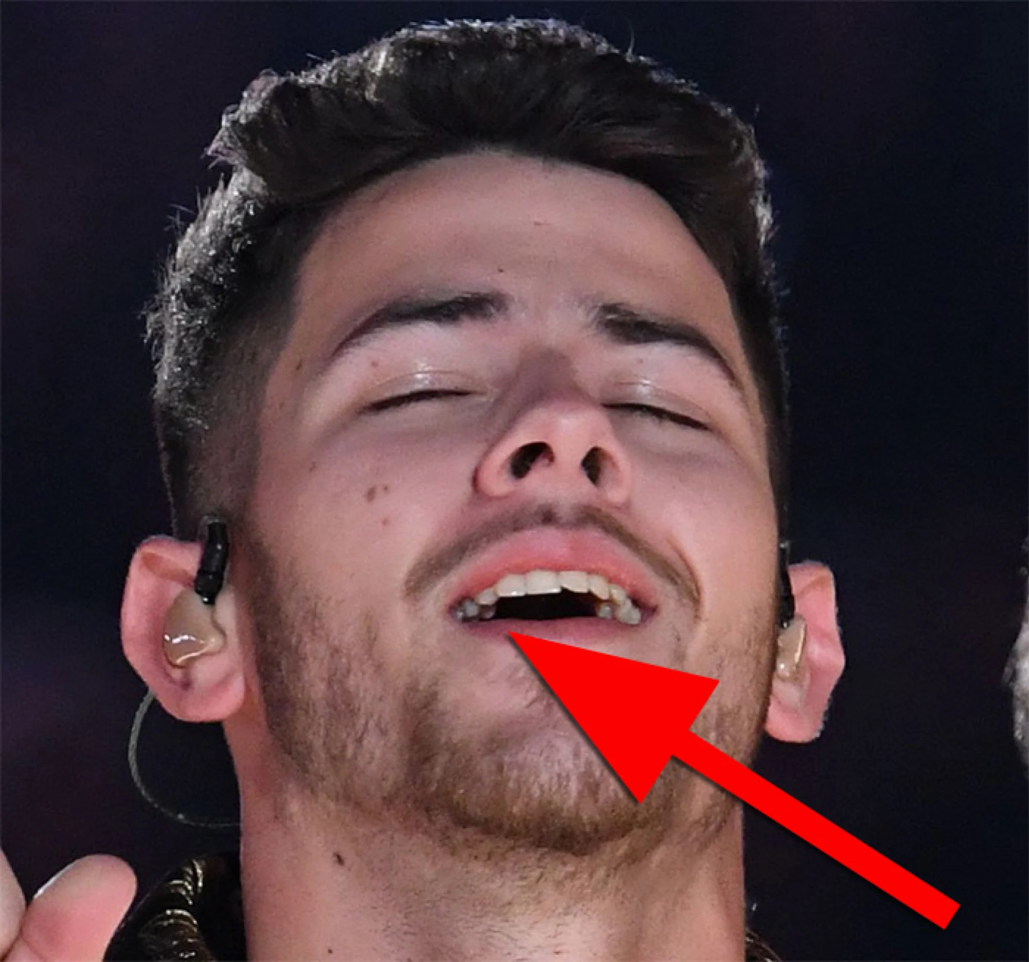 Nick Jonas Teeth Transformation 2026: The Truth Behind His 3 Front ...